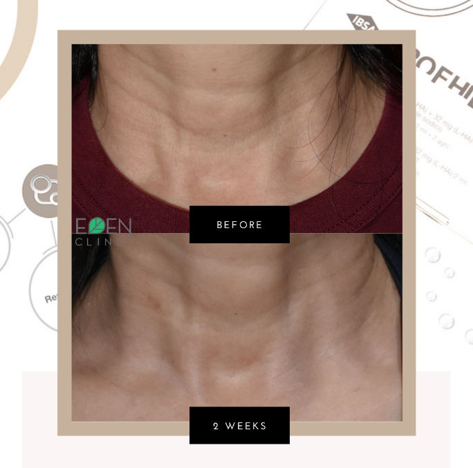 Profhilo | Treatment